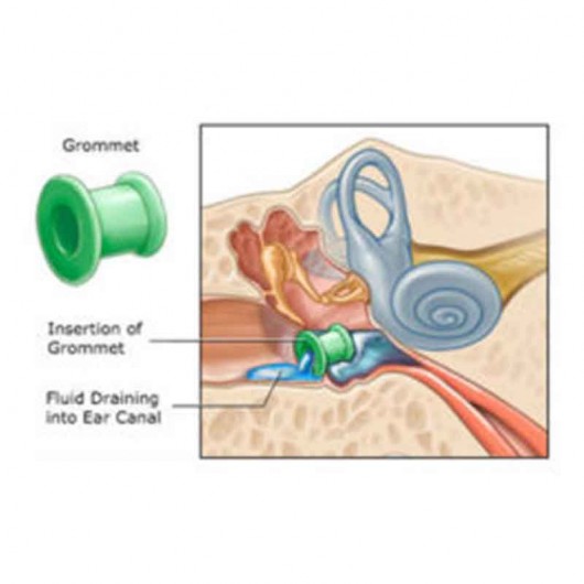 Grommet Insertion Operation At Kathleen Perry Blog Grommet Insertion Operation At Kathleen Perry Blog